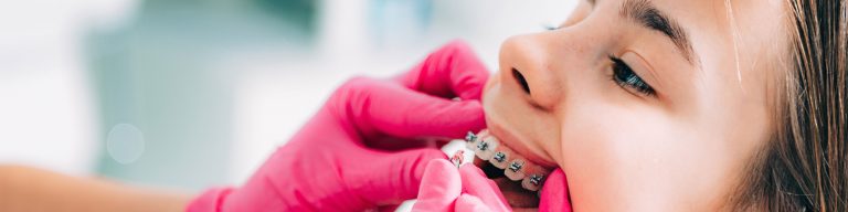 Buitenboordbeugel – Orthodontiepraktijk Vianen | Alexander Nassy