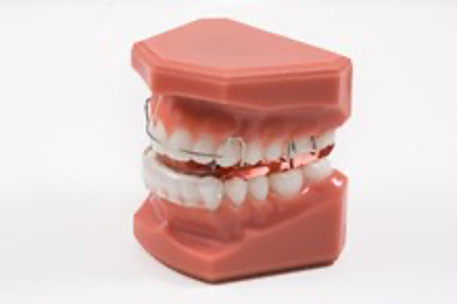 Blokbeugel – Orthodontiepraktijk Vianen | Alexander Nassy